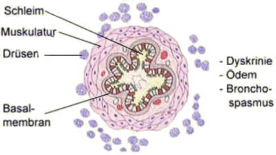 Asthma bronchiale (Bronchialasthma) – Allum – Allergie, Umwelt und ...